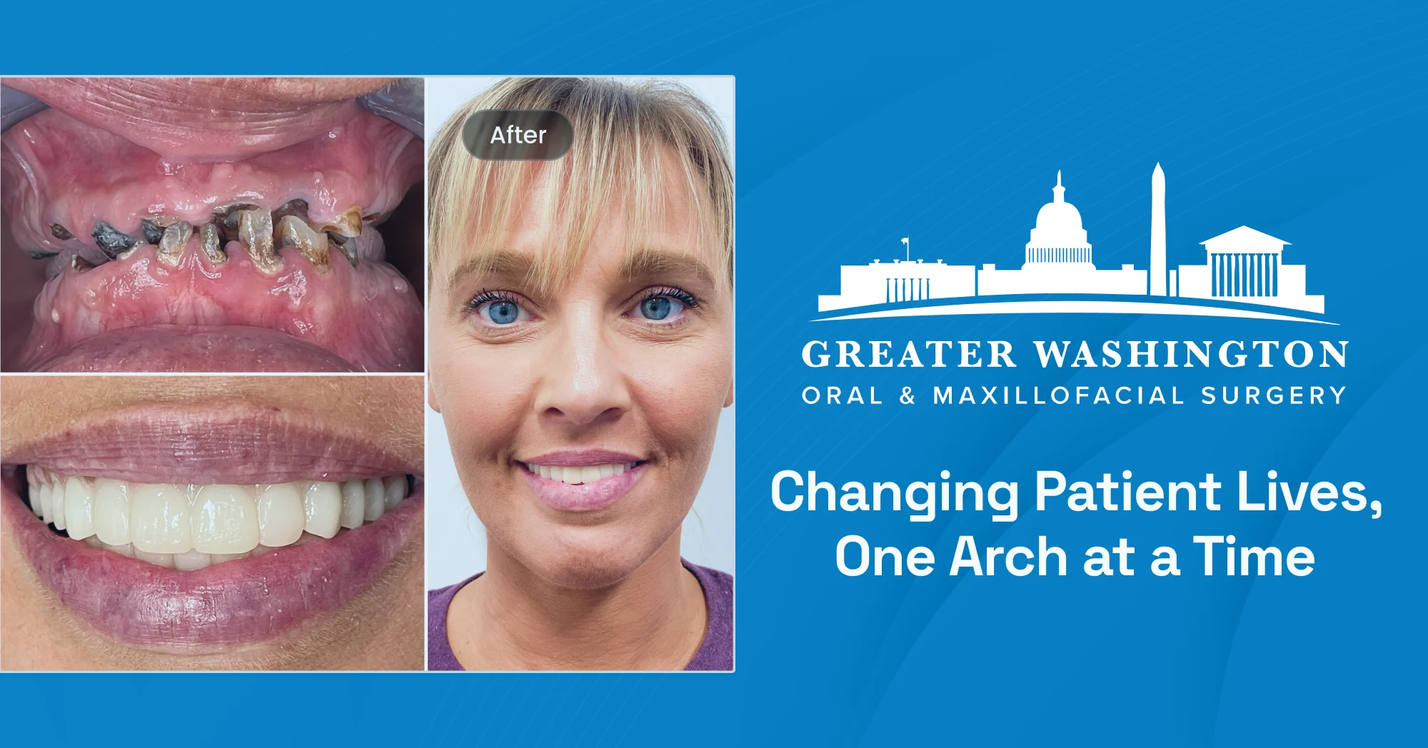 Post-Operative Archives | Greater Washington Oral & Maxillofacial Surgery