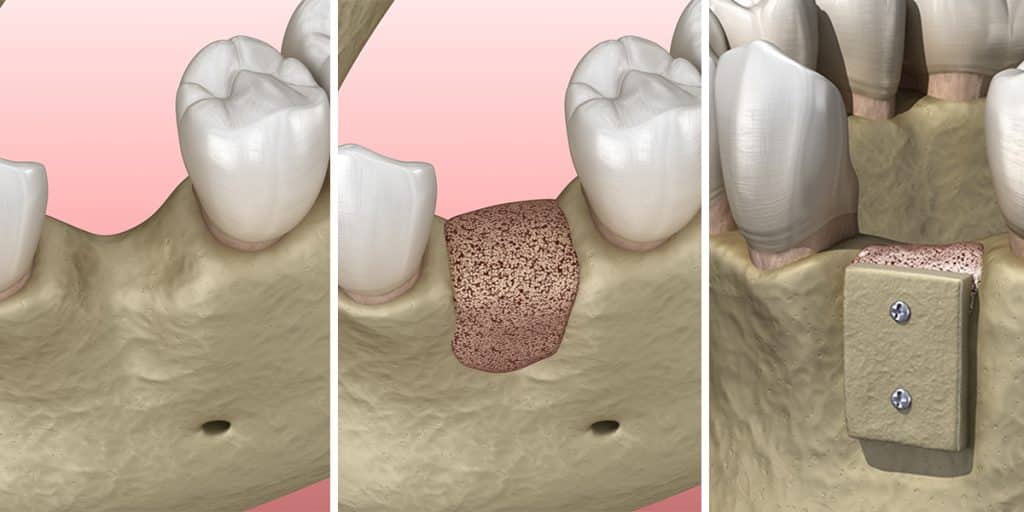 Bone Grafting in Northern VA | Greater Washington OMFS